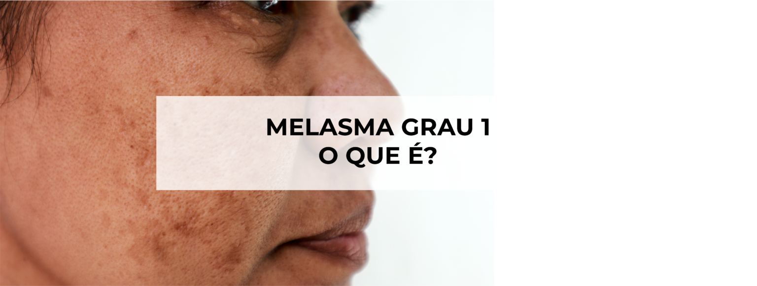 Tipos de melasma: como identificar cada grau - Blog Ada Tina