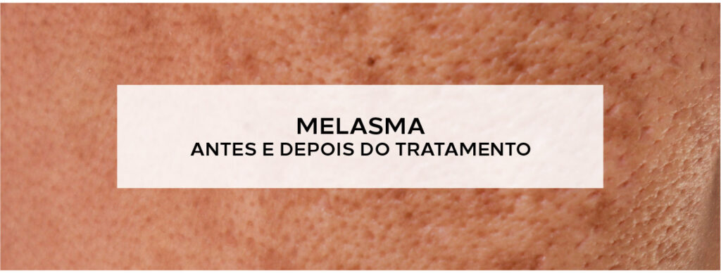 Melasma: confira o antes e depois do tratamento - Blog Ada Tina