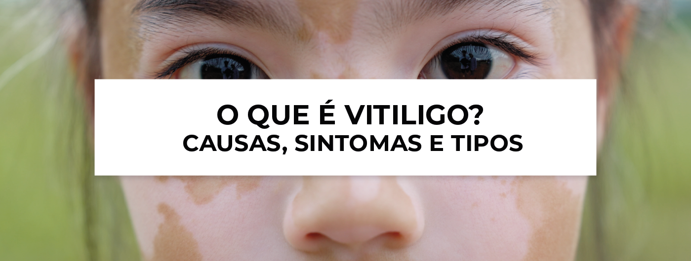 O QUE É VITILIGO? CAUSAS, SINTOMAS E TIPOS - Blog Ada Tina