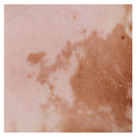 O QUE É VITILIGO? CAUSAS, SINTOMAS E TIPOS - Blog Ada Tina