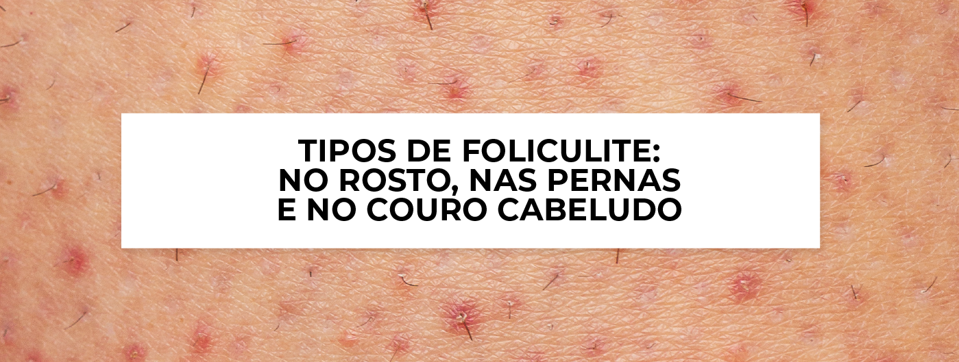 Tipos de foliculite: no rosto, nas pernas e no couro cabeludo - Blog ...