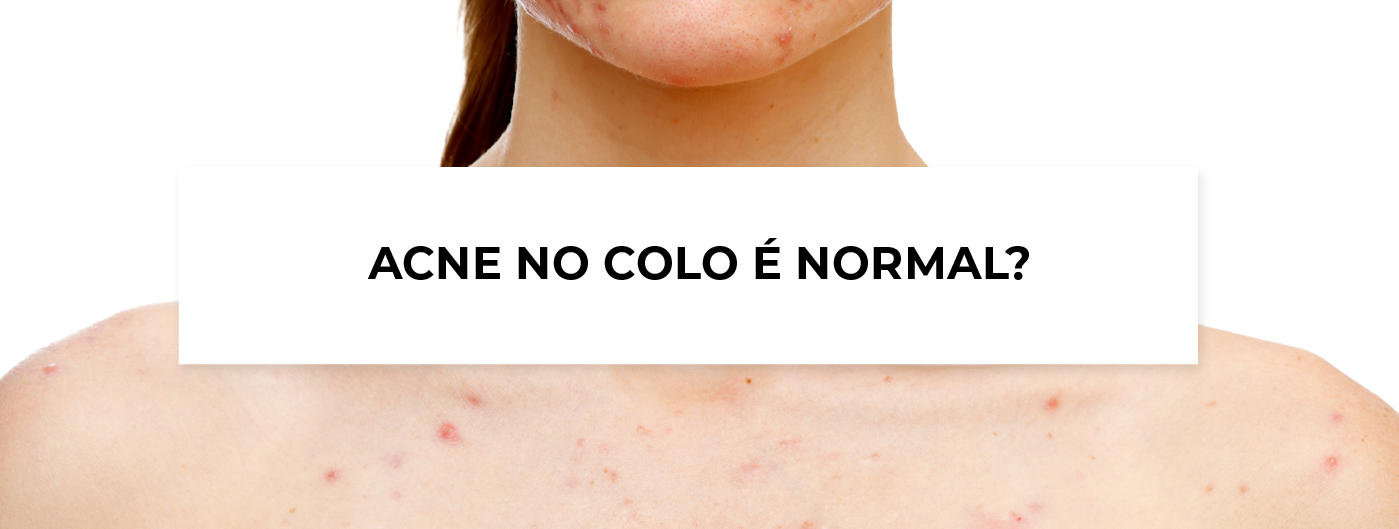 Acne no colo é normal? - Blog Ada Tina