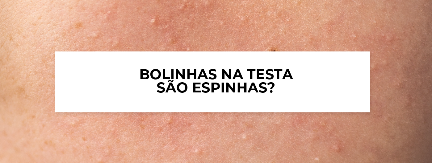 Bolinhas na testa são espinhas? - Blog Ada Tina