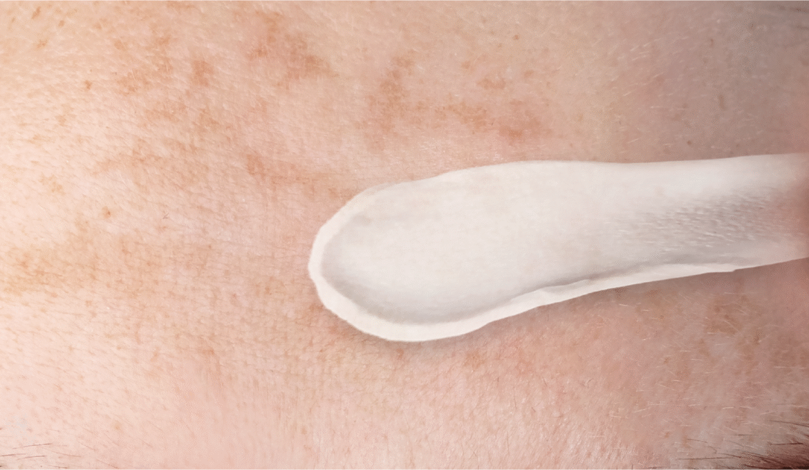 Melasma na testa: como tratar com segurança e produtos dermatológicos ...